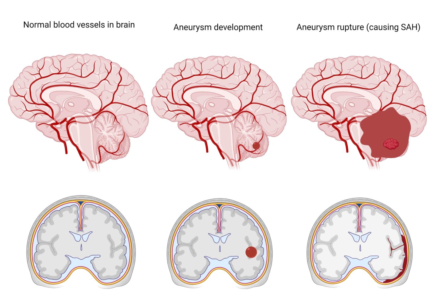 Biological and Medical Mechanisms of Intracranial Aneurysms and ...
